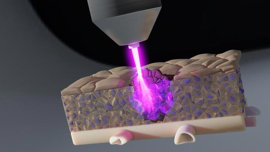 Cold Plasma Jet Technology Penetrates Deep Tissue Layers To Target ...